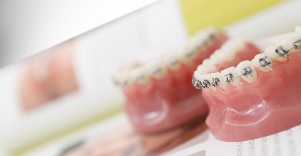 festsitzende Spangen - KiO4U – Ihre Zahnarztpraxis in Gera